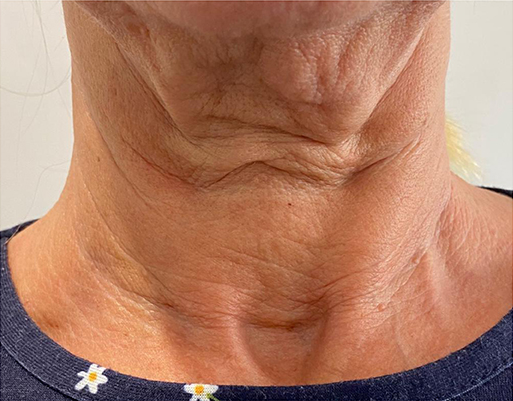 Skin Tightening Treatment | Body Sculpting | Rossendale