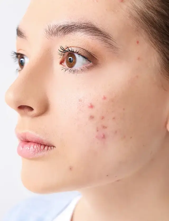 GlycoAla PDT Acne Treatment | Blemish Clinic